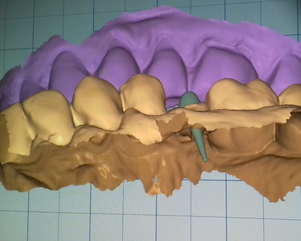 Faux-moignon tout Zircone | LABORATOIRE STYDENTAL